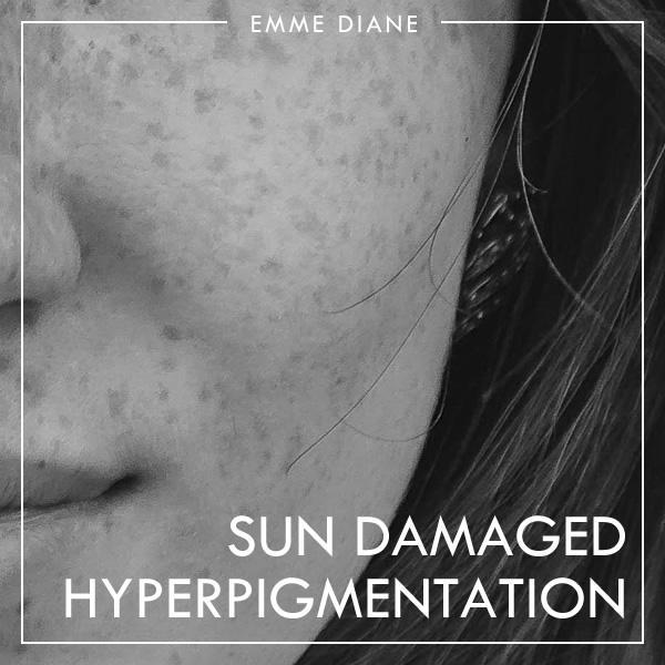 Hyperpigmented Skin | Skincare Products For Sun Damage | Emme Diane
